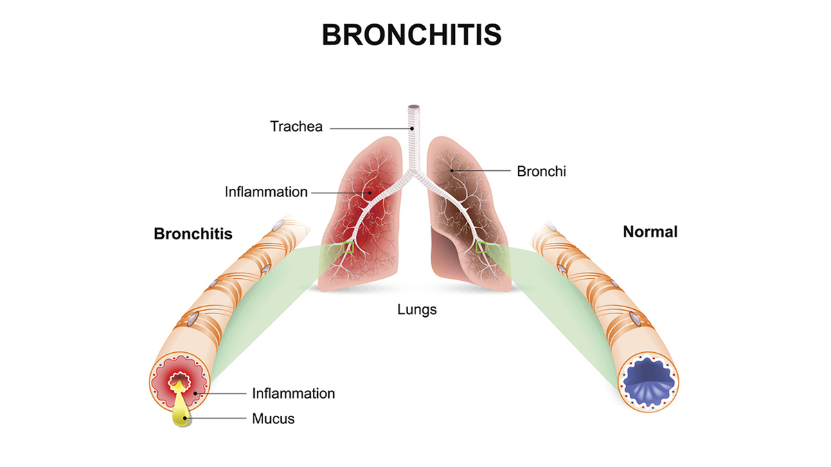Chest Cold Acute Bronchitis Basics Acute Bronchitis CDC Chest Cold Acute Bronchitis Basics Acute Bronchitis CDC