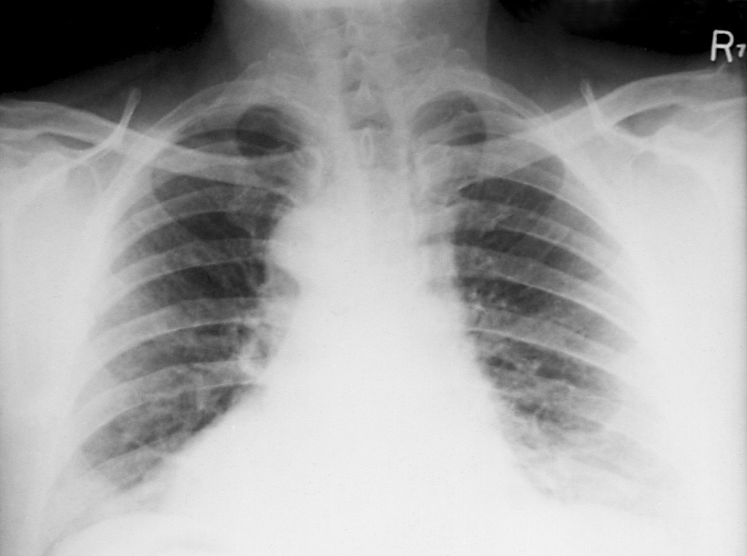 About Anthrax | Anthrax | CDC