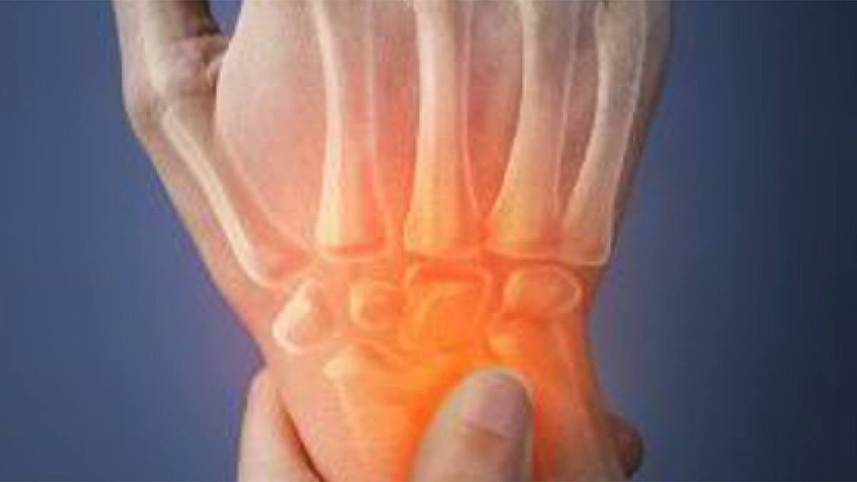 Arthritis | Chronic Disease Indicators | CDC