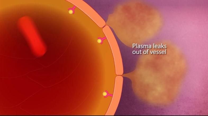 CDC-DCCM-Plasma Leakage Video