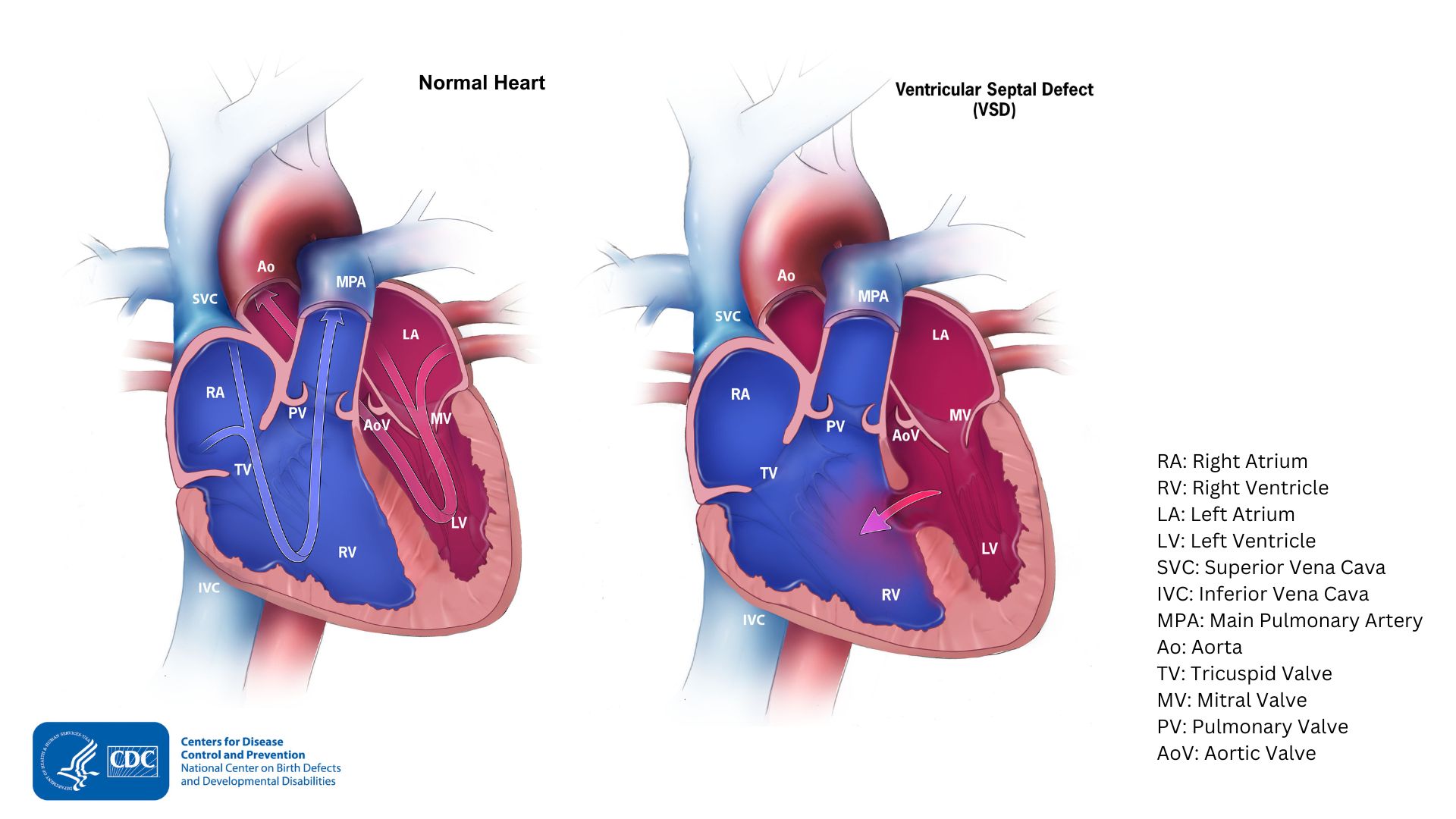 About Ventricular Septal Defect Congenital Heart Defects CHDs CDC