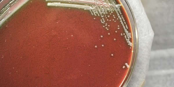 Notes from the Field: Francisella tularensis Type B Infection from a ...