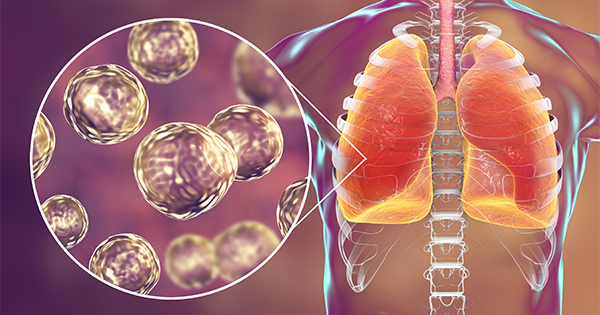 Notes from the Field: Blastomycosis Cases Occurring Outside of Regions ...