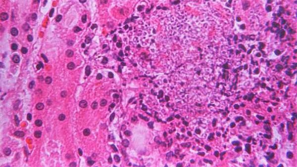 Candida Bloodstream Infections Among Persons Who Inject Drugs — Denver ...
