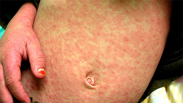 Progress Toward Measles Elimination — European Region, 2009–2018 | MMWR