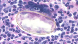 About Paragonimiasis | Paragonimiasis | CDC