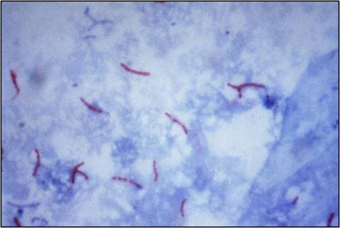 5. Bacteriological Examination – Examination of Smears for AFB