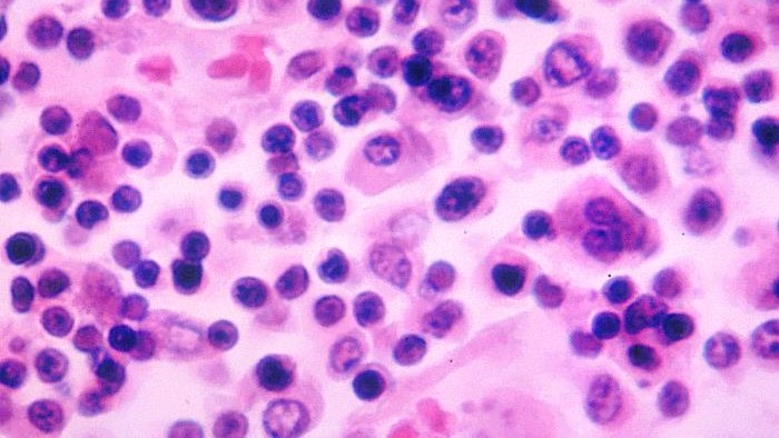 Clinician Resources for Typhoid Fever and Paratyphoid Fever | Typhoid ...